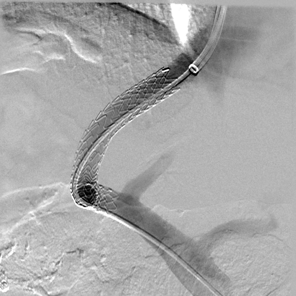 Vascular and Interventional Radiology | Department of Radiology ... Vascular and Interventional Radiology | Department of Radiology ...